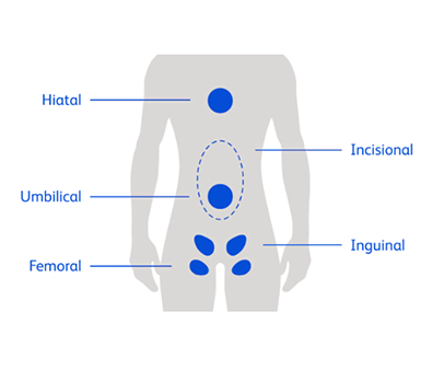 A Comprehensive Guide To Hernias A Comprehensive Guide To Hernias