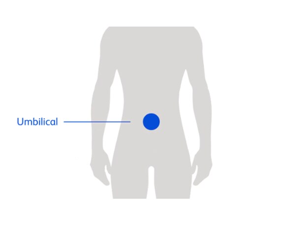 Hernia Types: Umbilical Hernias